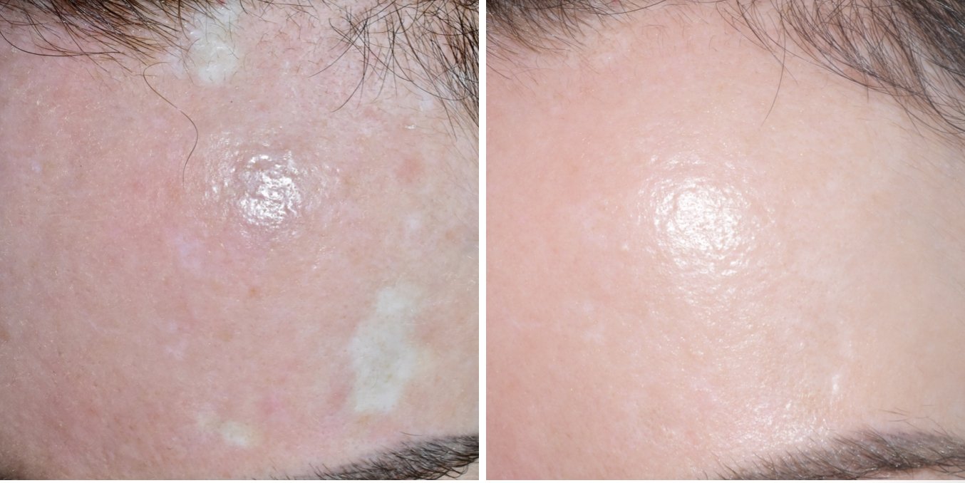 Cosmetic Tattoo Repair | Sunshine Coast Cosmetic Tattoo Clinic