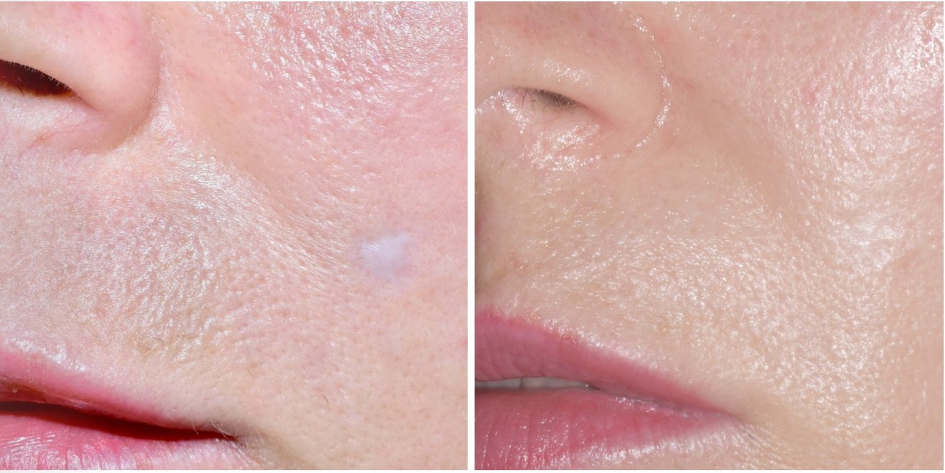 Cosmetic Tattoo Repair | Sunshine Coast Cosmetic Tattoo Clinic