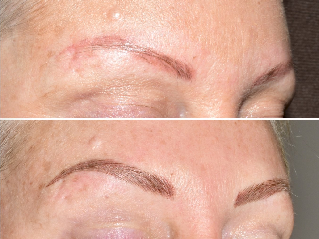 Cosmetic Tattoo Repair | Sunshine Coast Cosmetic Tattoo Clinic