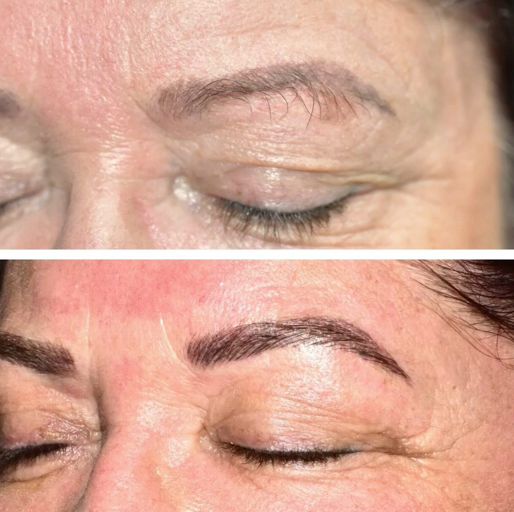 Cosmetic Tattoo Repair | Sunshine Coast Cosmetic Tattoo Clinic