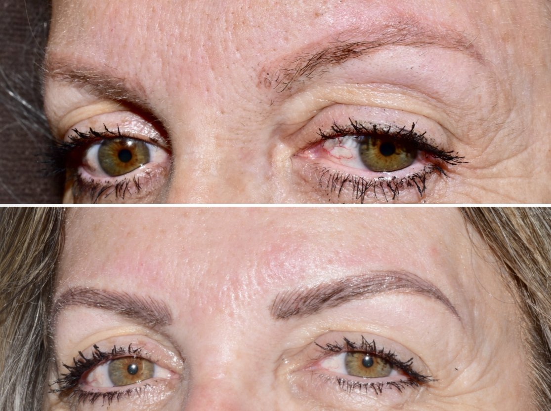 Cosmetic Tattoo Repair | Sunshine Coast Cosmetic Tattoo Clinic